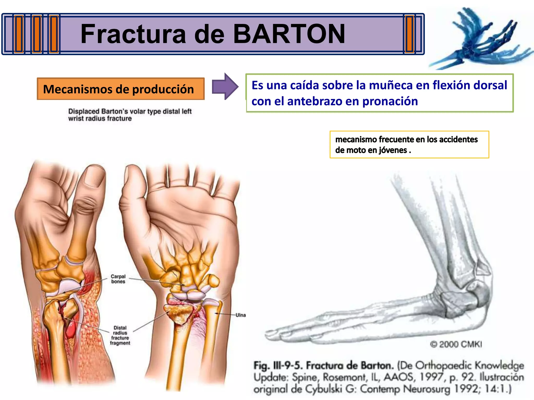 11 fracturas deñ tercio distal del humero | PPT