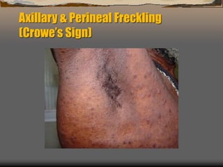 genetic diseases | PPT