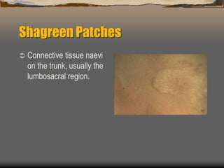 genetic diseases | PPT