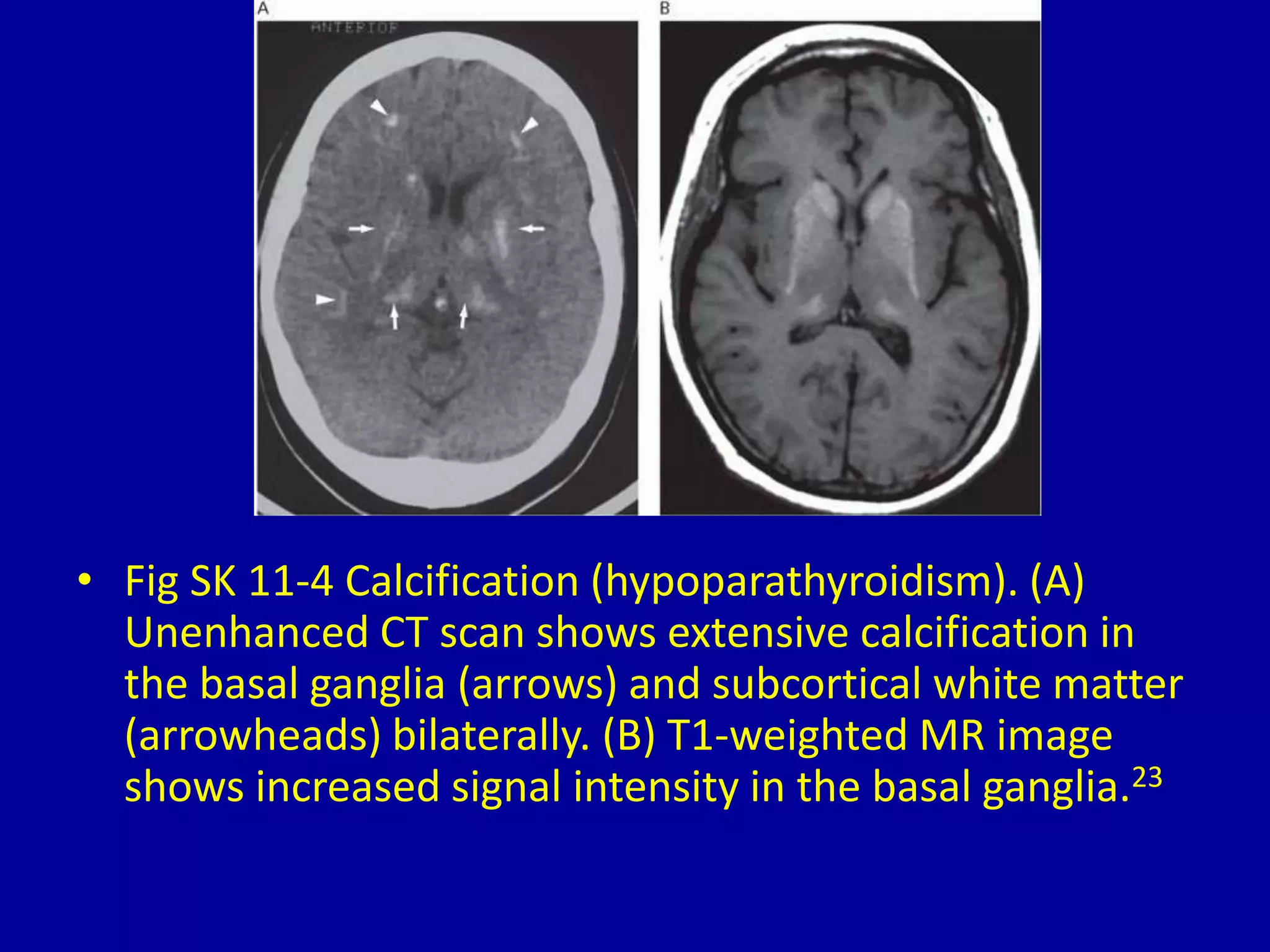 11 hyperintense basal ganglia on t1 weighted magnetic resonance | PPTX