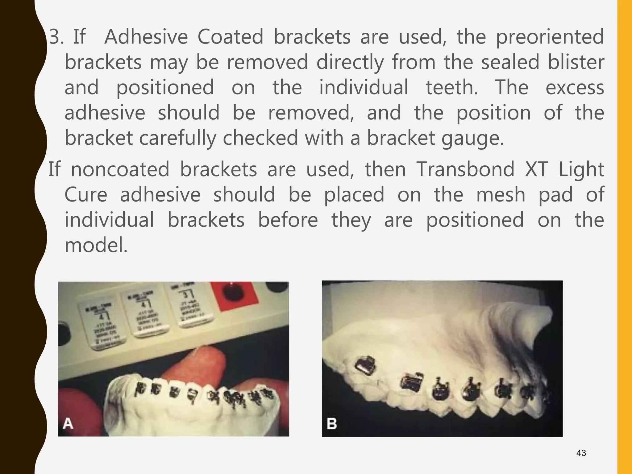 indirect bonding | PPTX