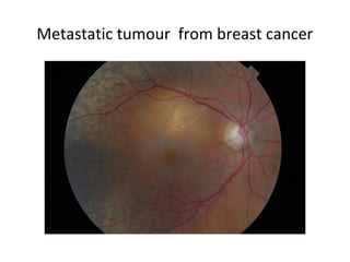 Intraocular Tumours | PPT