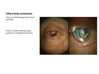 Intraocular Tumours | PPT