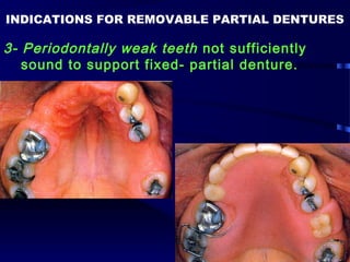 introduction to removable partial denture | PPT