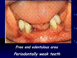 introduction to removable partial denture | PPT
