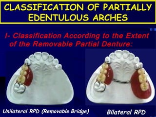 introduction to removable partial denture | PPT