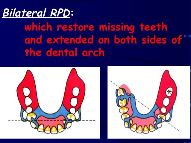 introduction to removable partial denture