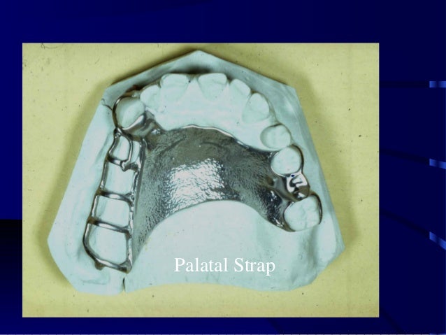 introduction to removable partial denture