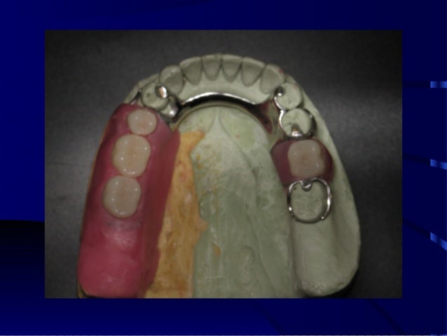 introduction to removable partial denture