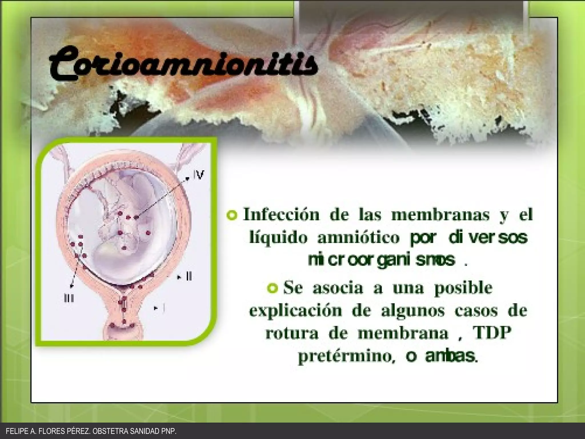 Maduración pulmonar fetal. Corioamnionitis. Shock septico | PPT