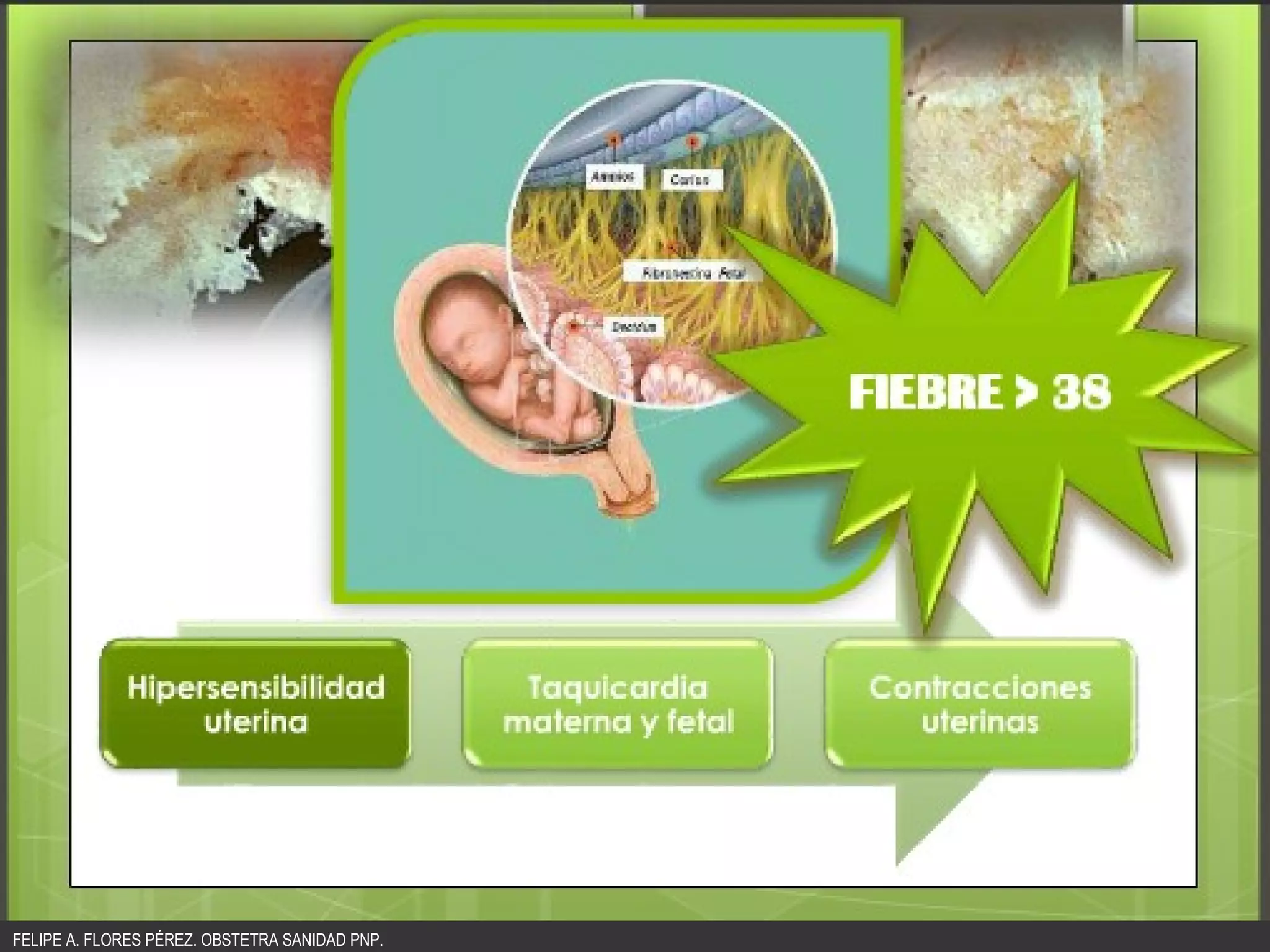 Maduración pulmonar fetal. Corioamnionitis. Shock septico | PPT