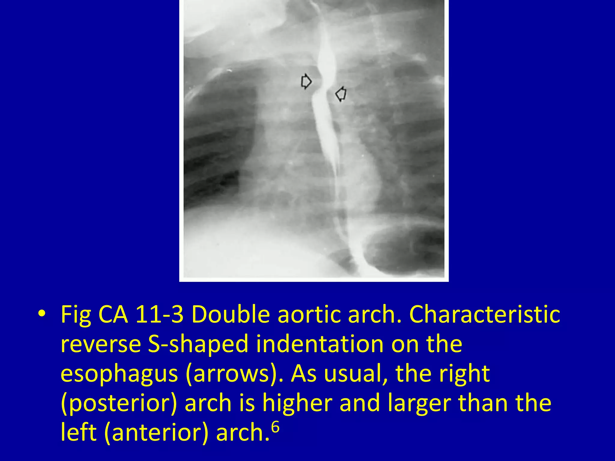 11 major anomalies of the aortic arch and | PPTX