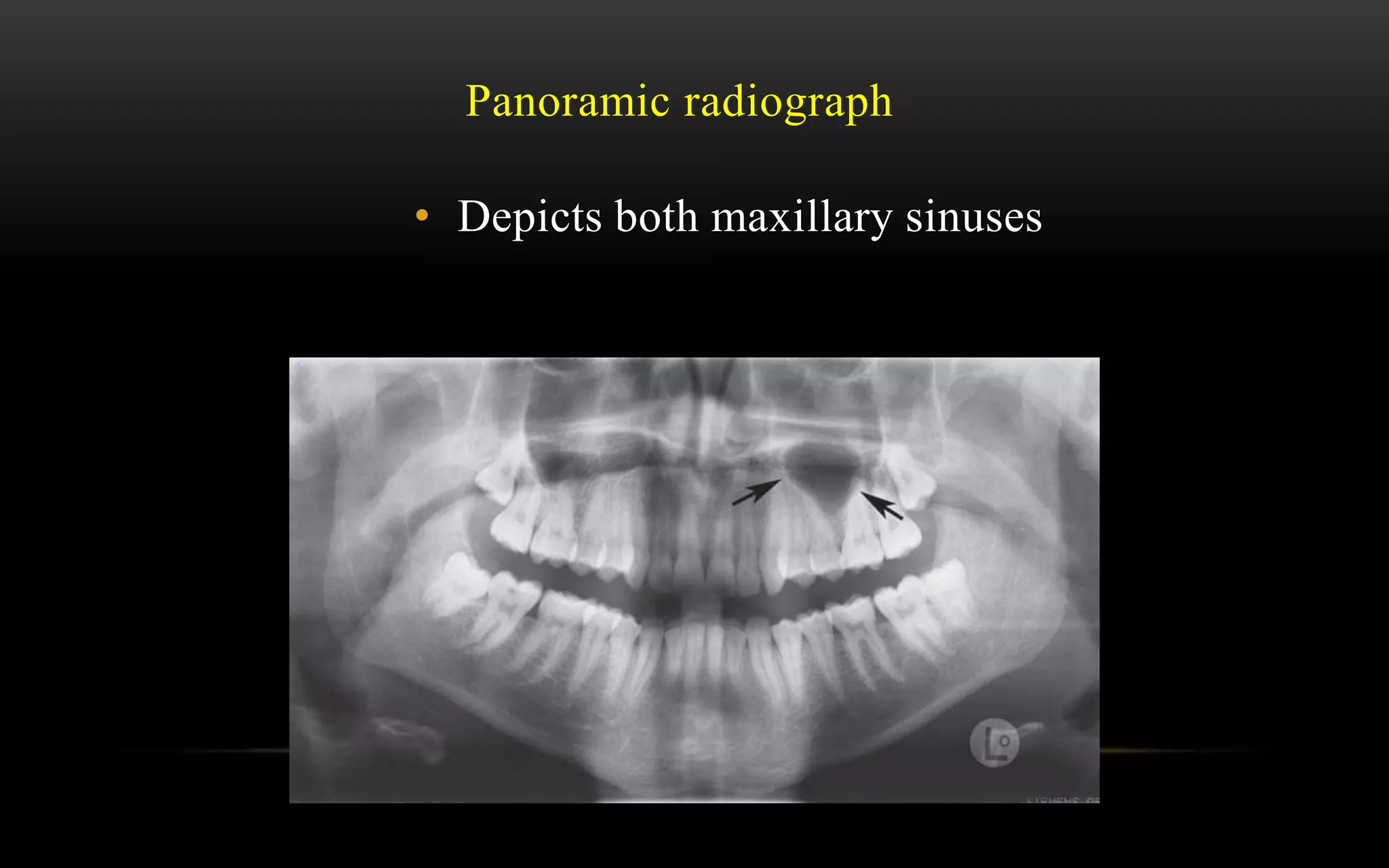 Differential diagnosis of haziness of maxillary sinus | PPTX