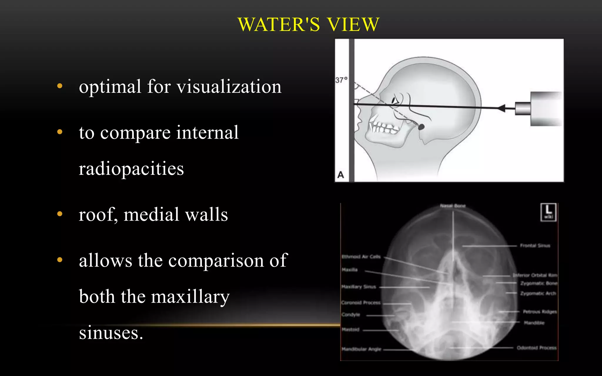 Differential diagnosis of haziness of maxillary sinus | PPTX