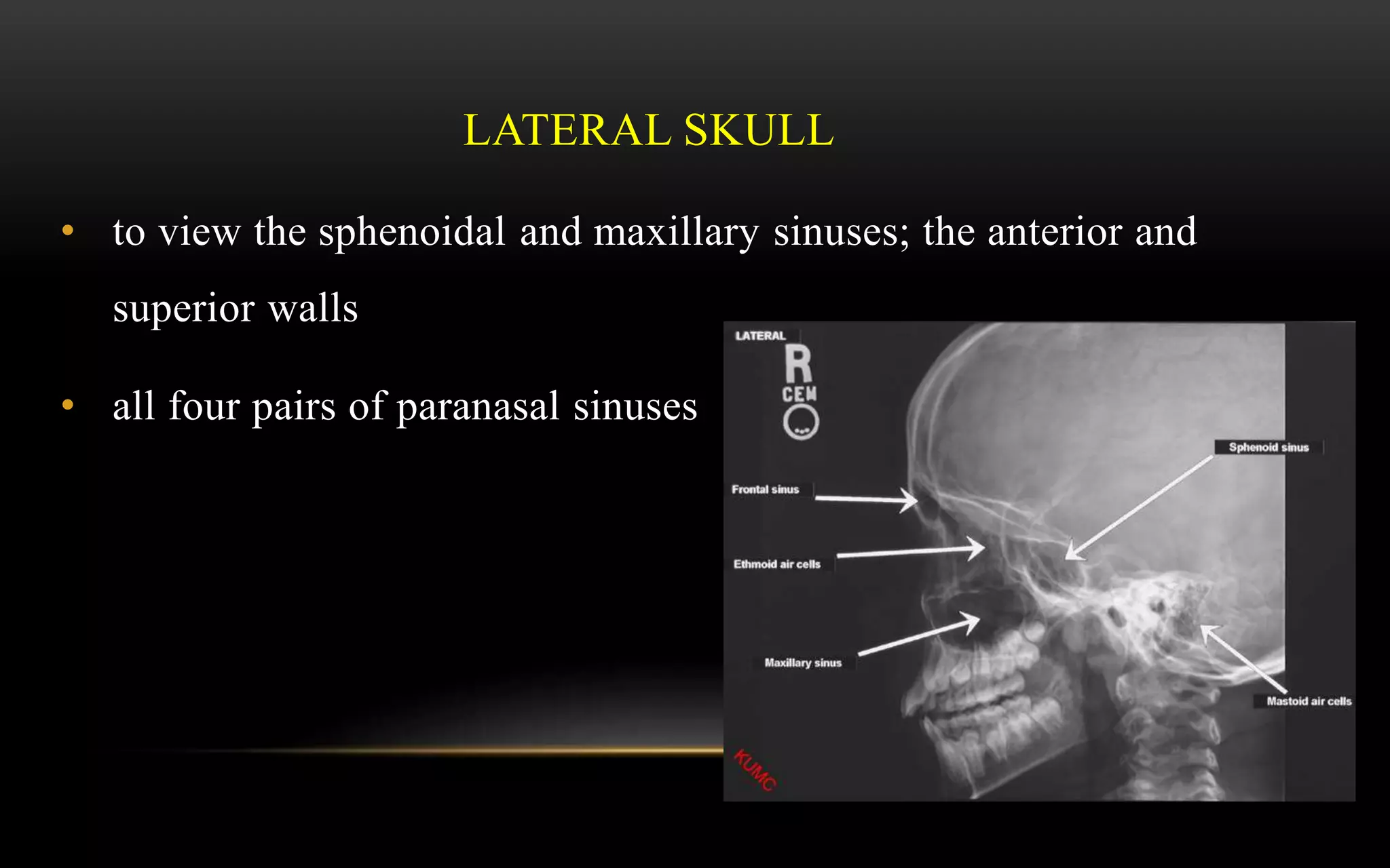 Differential diagnosis of haziness of maxillary sinus | PPTX