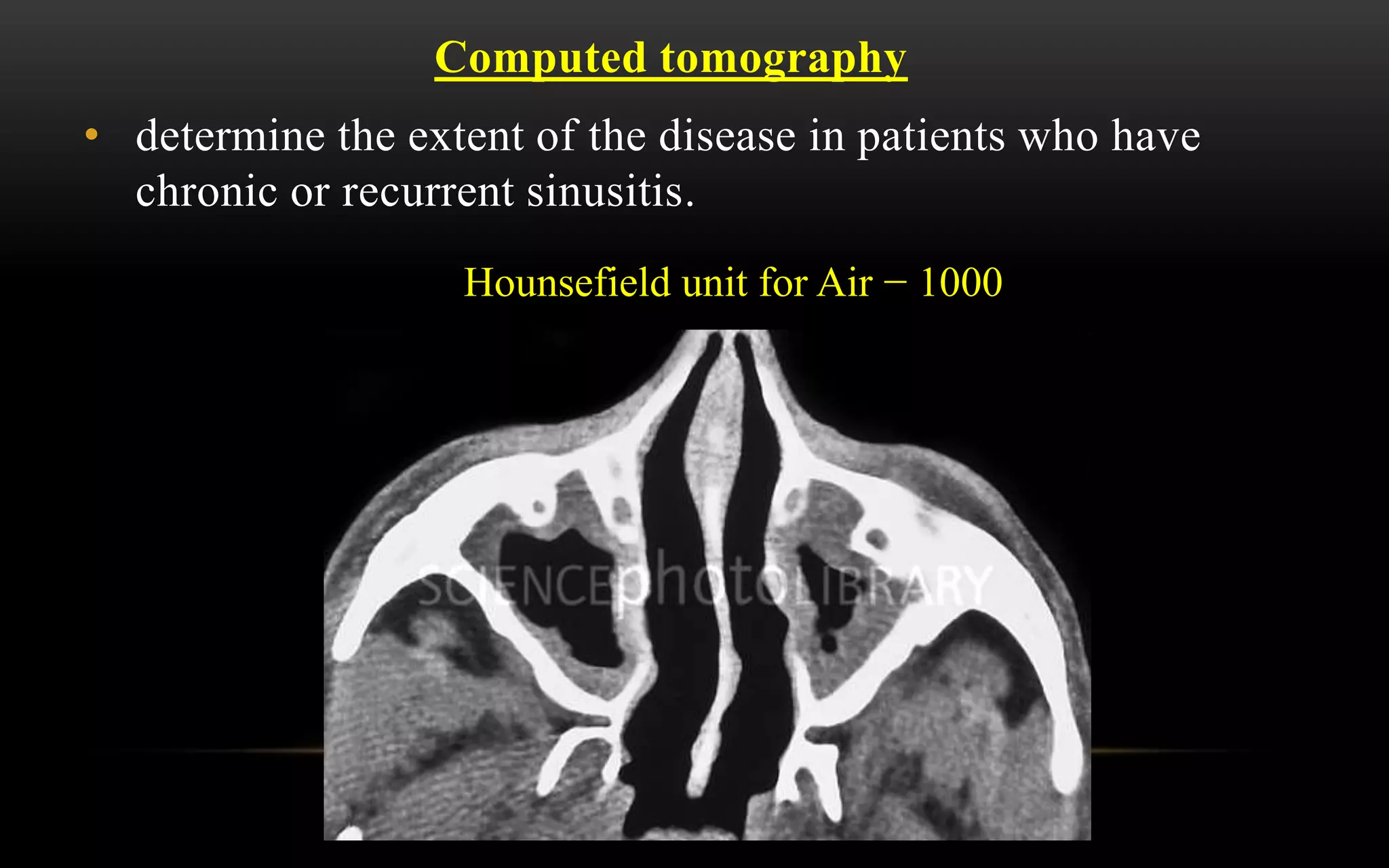 Differential diagnosis of haziness of maxillary sinus | PPTX