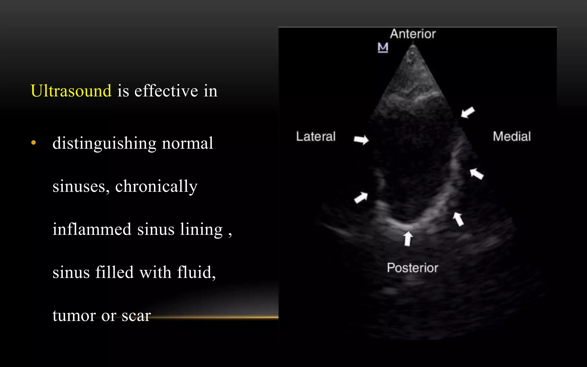 Differential diagnosis of haziness of maxillary sinus | PPTX