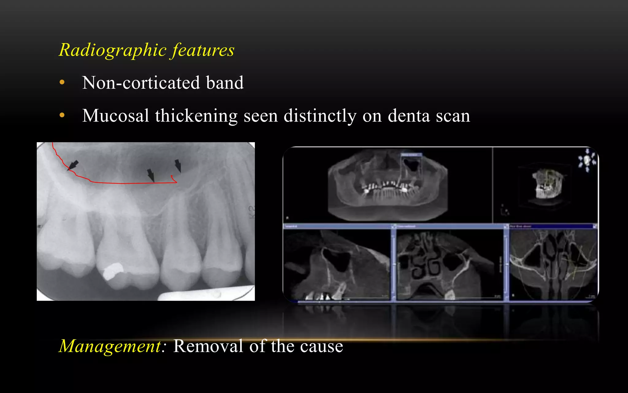 Differential diagnosis of haziness of maxillary sinus | PPTX