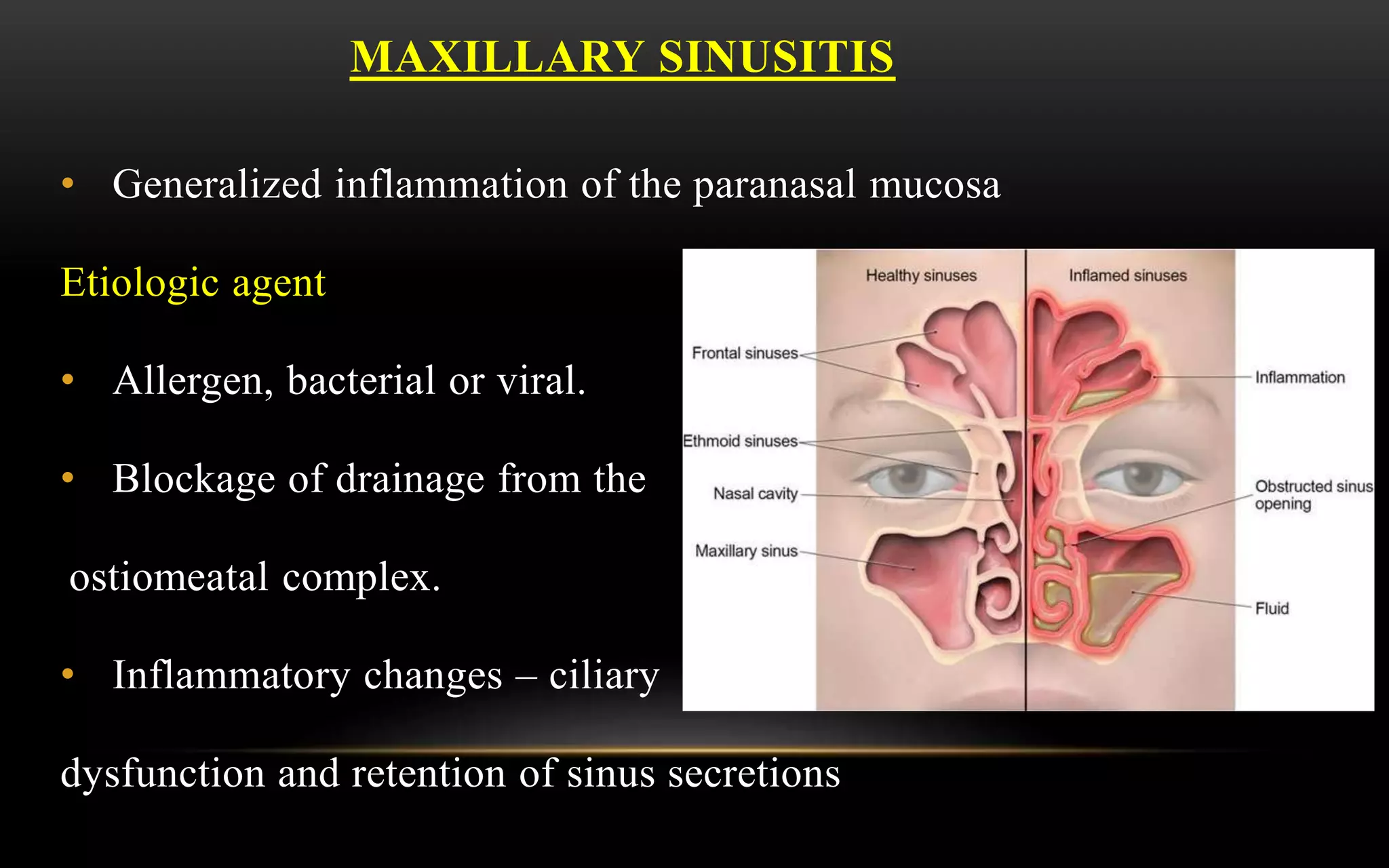 Differential diagnosis of haziness of maxillary sinus | PPTX