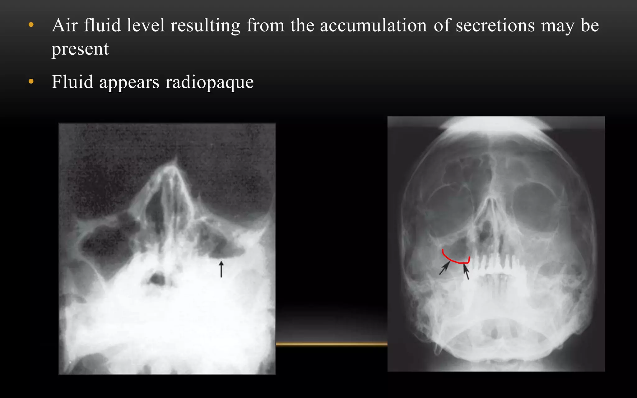 Differential diagnosis of haziness of maxillary sinus | PPTX