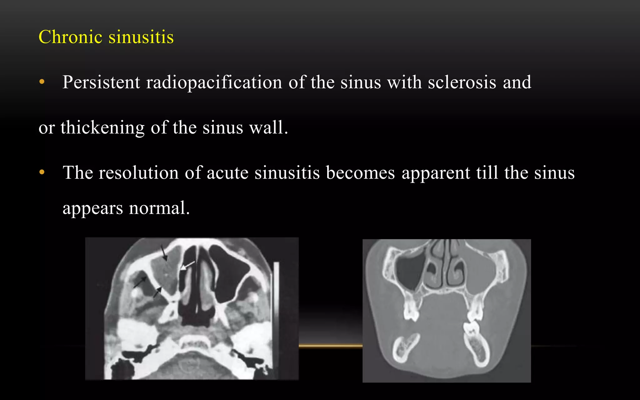 Differential diagnosis of haziness of maxillary sinus | PPTX