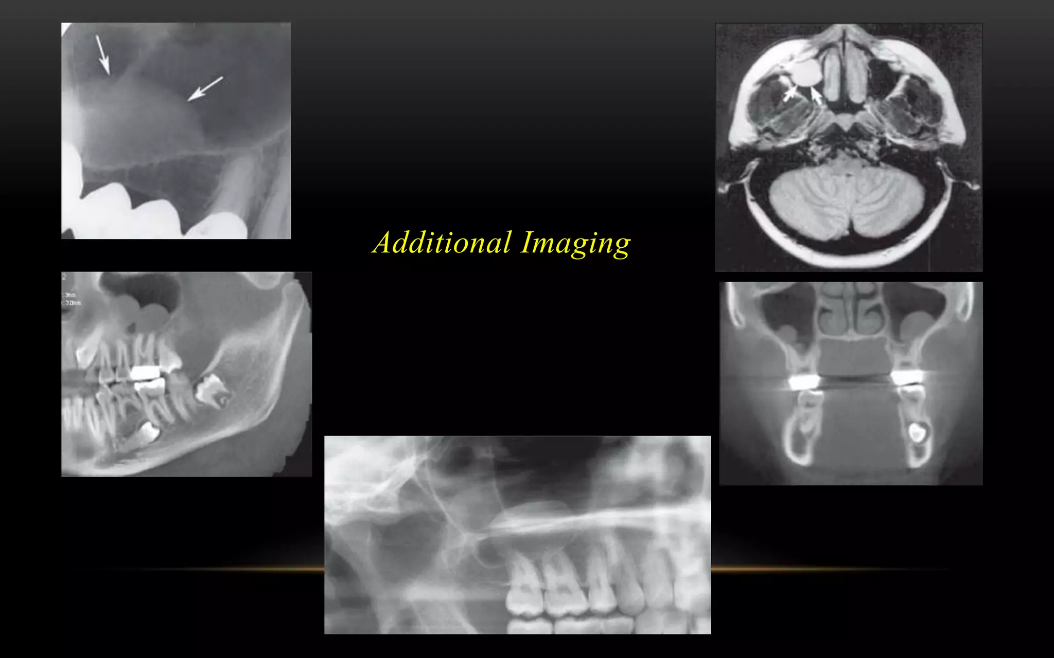 Differential diagnosis of haziness of maxillary sinus | PPTX