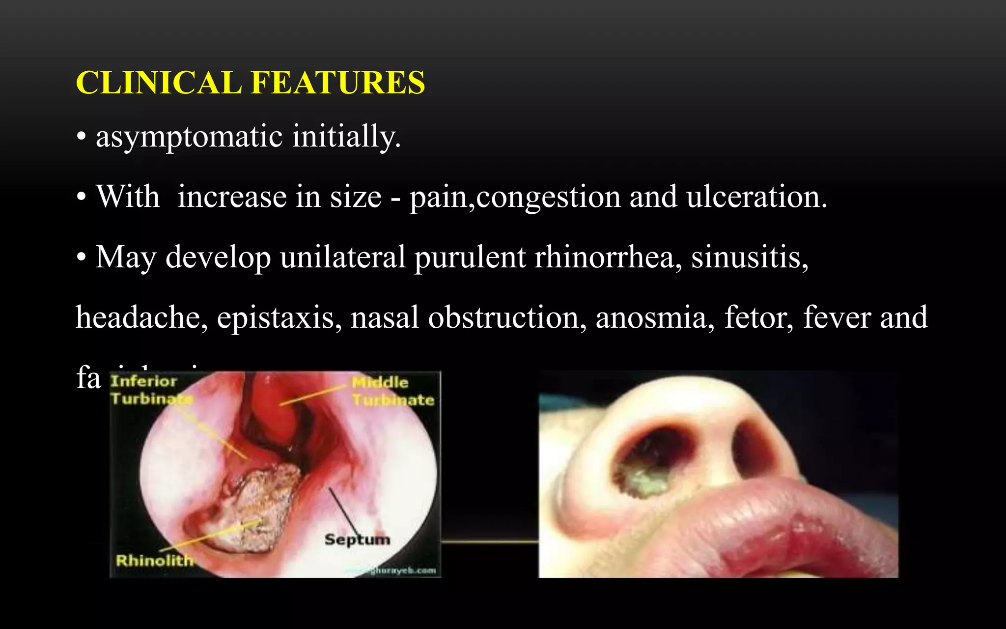 Differential diagnosis of haziness of maxillary sinus | PPTX
