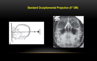 Differential diagnosis of haziness of maxillary sinus | PPTX