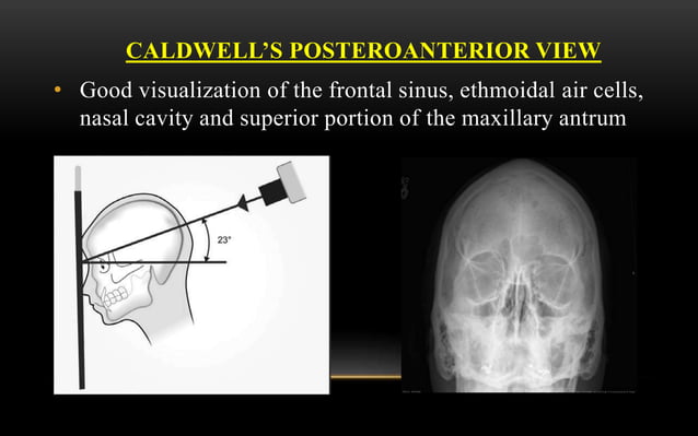Differential diagnosis of haziness of maxillary sinus | PPTX | Ear ...