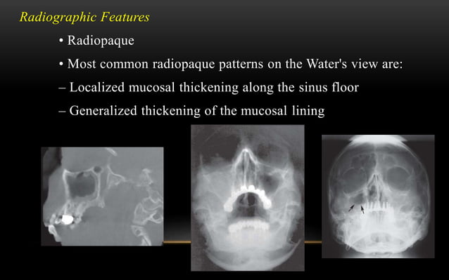 Differential diagnosis of haziness of maxillary sinus | PPTX | Ear ...