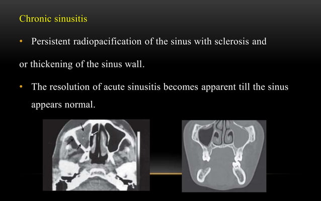 Differential diagnosis of haziness of maxillary sinus | PPTX | Ear ...