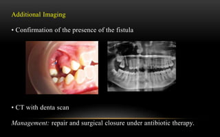 Differential diagnosis of haziness of maxillary sinus | PPTX