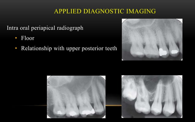 Differential diagnosis of haziness of maxillary sinus | PPTX | Ear ...