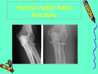 fracture radial head | PPTX
