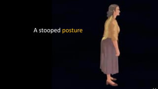 #11 osteoporosis | PPT