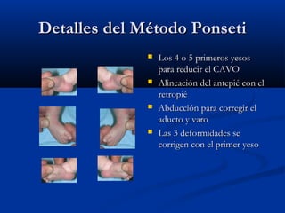 11 pie equino varo congenito | PPT