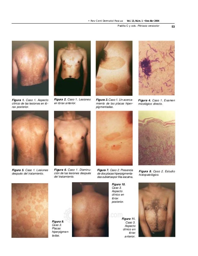 pitiriasis versicolor presentación de tres casos clinicos