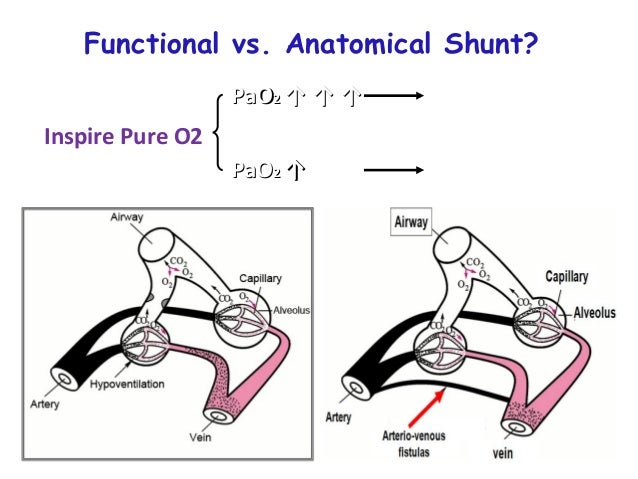 11 respiratory failure