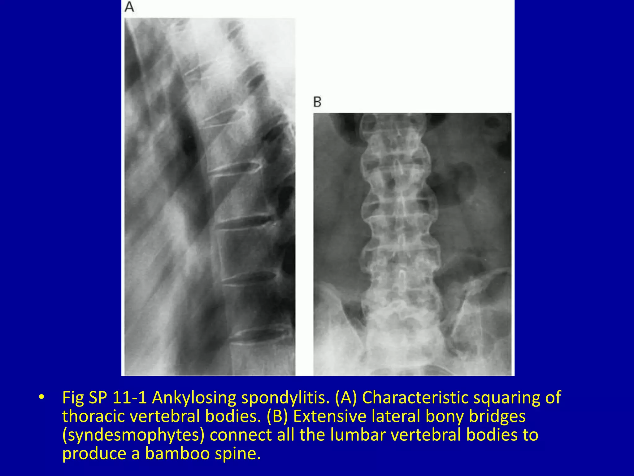 11 squaring of one or more vertebral bodies | PPTX | Bone and Joint ...