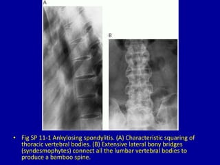 11 squaring of one or more vertebral bodies | PPTX | Bone and Joint ...
