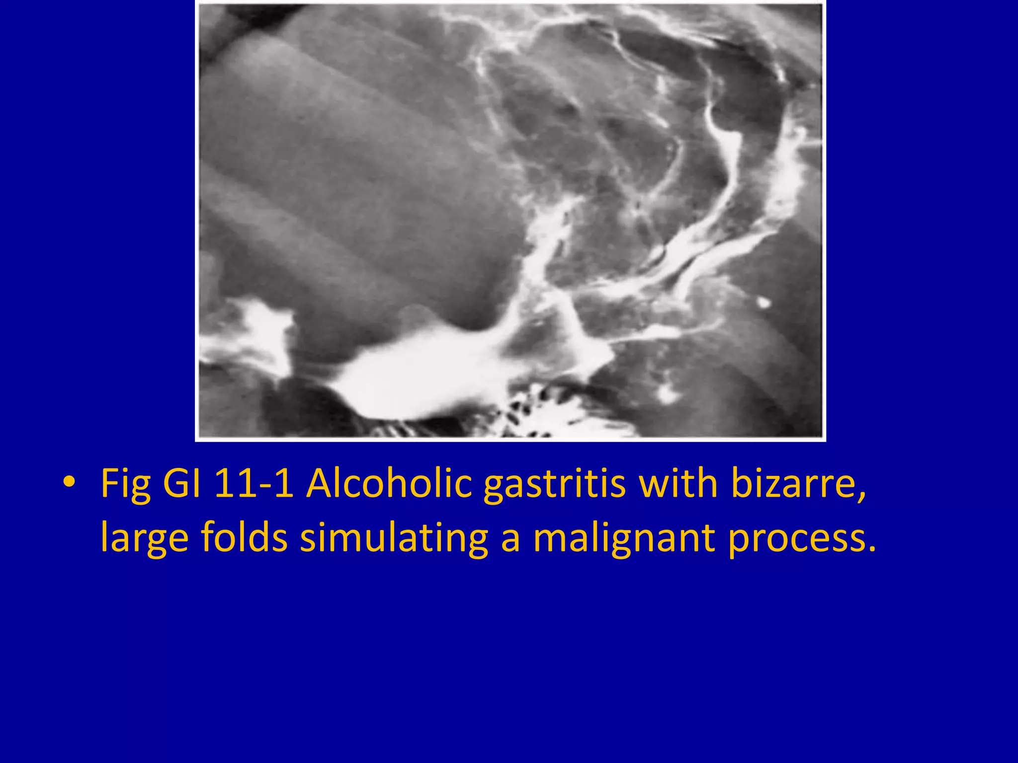 11 thickening of gastric folds | PPTX