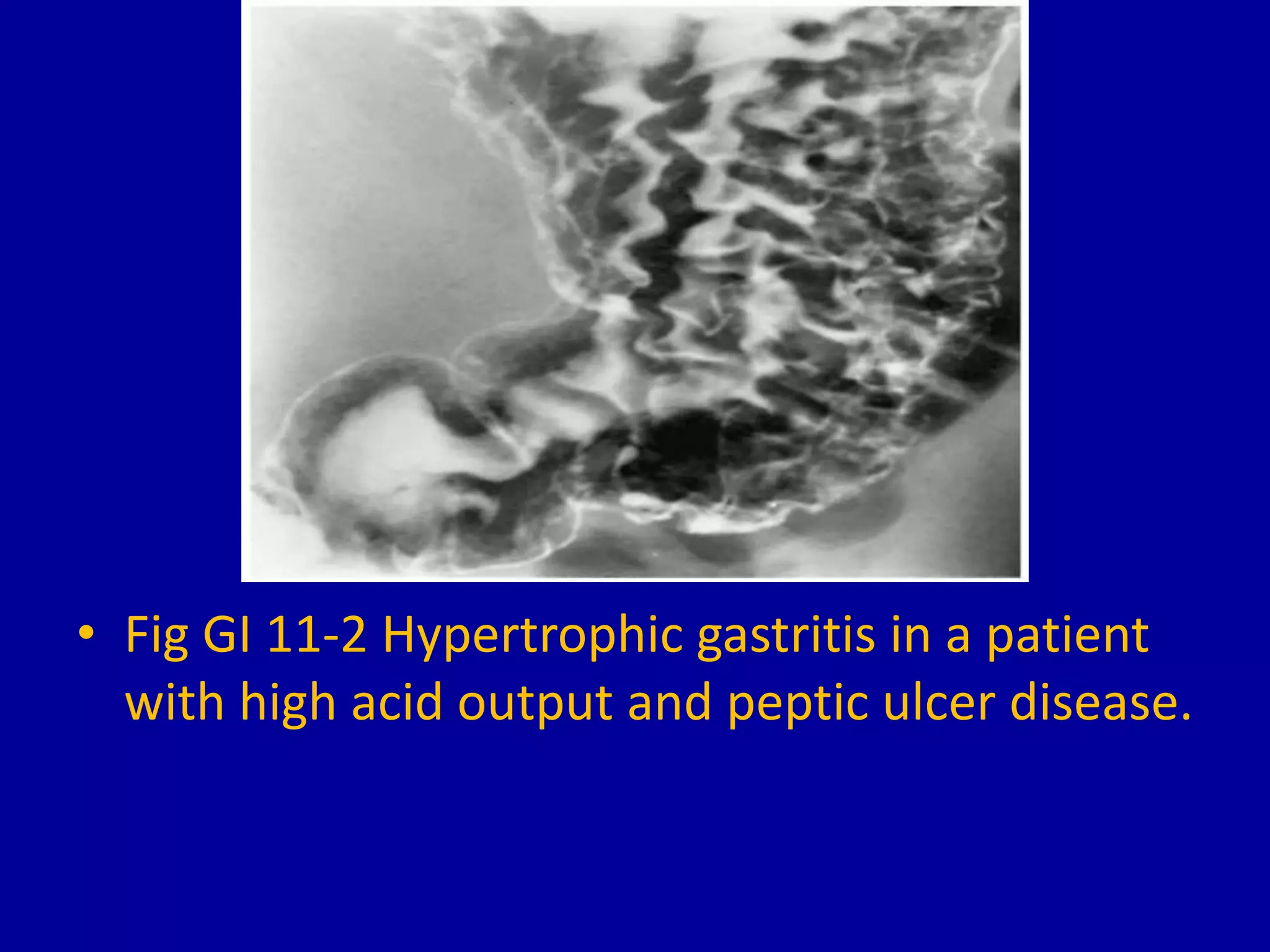 11 thickening of gastric folds | PPTX