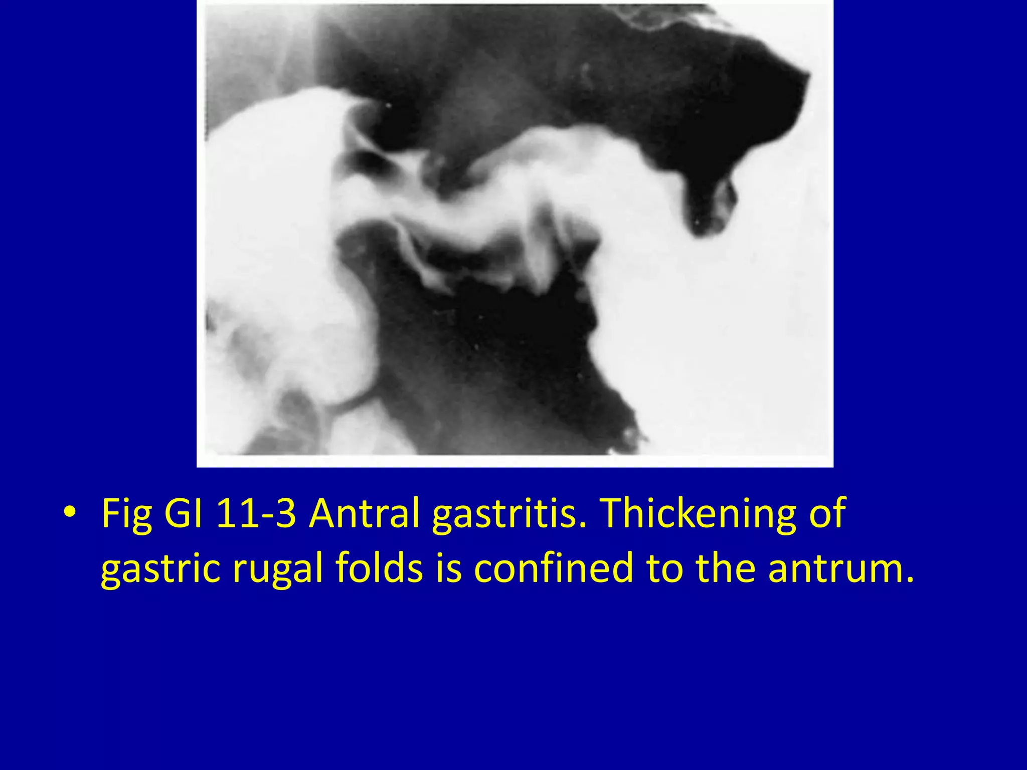 11 thickening of gastric folds | PPTX