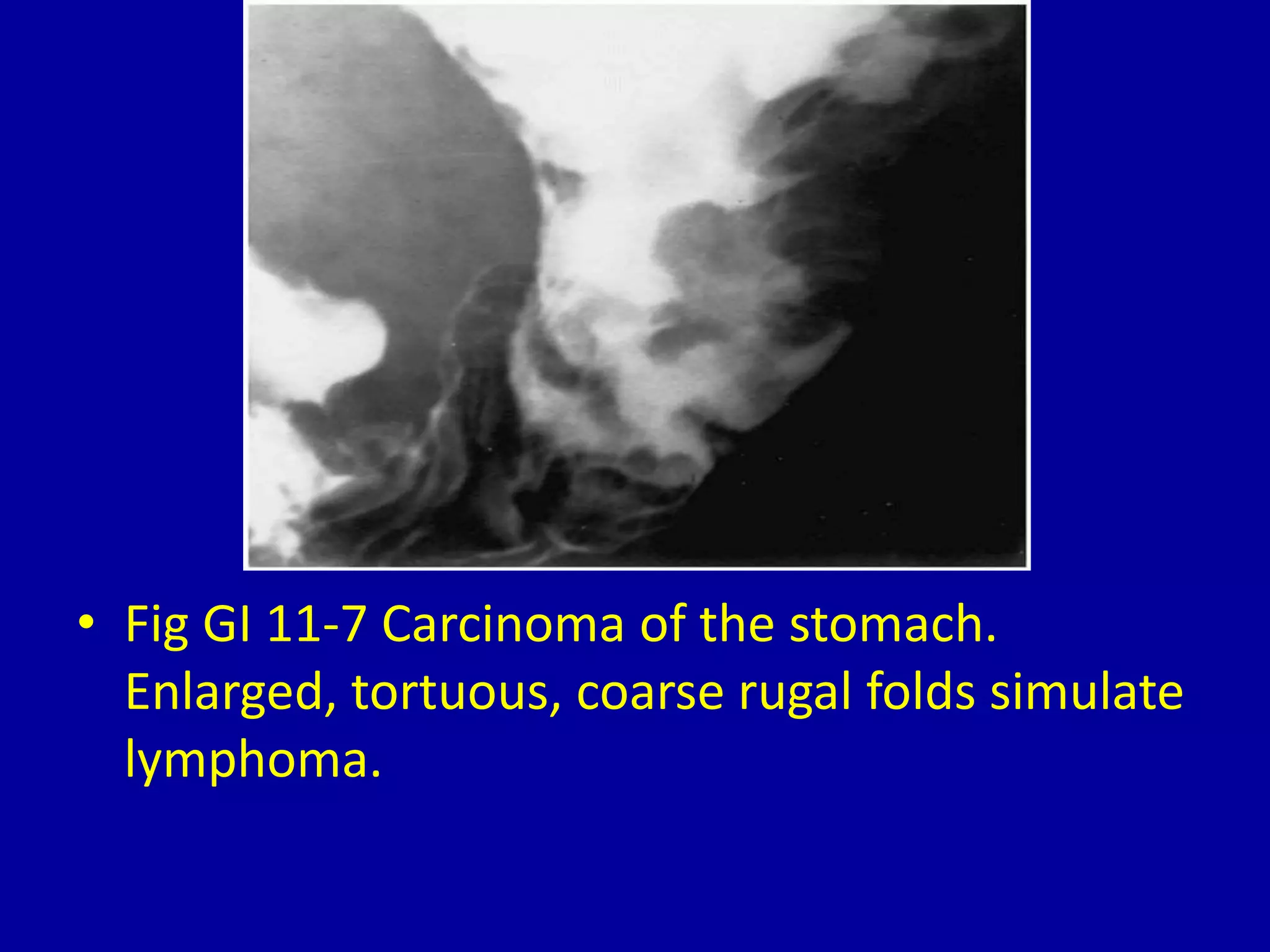 11 thickening of gastric folds | PPTX