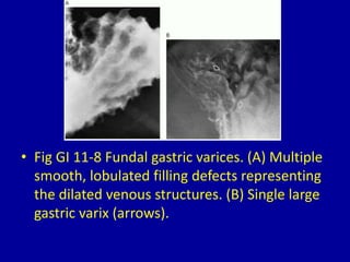 11 thickening of gastric folds | PPTX