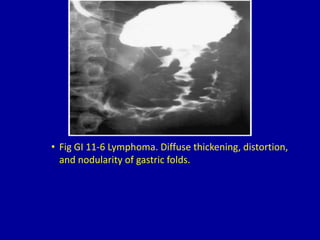 11 thickening of gastric folds | PPTX