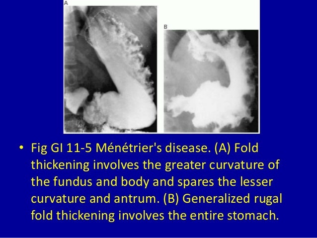 11 thickening of gastric folds