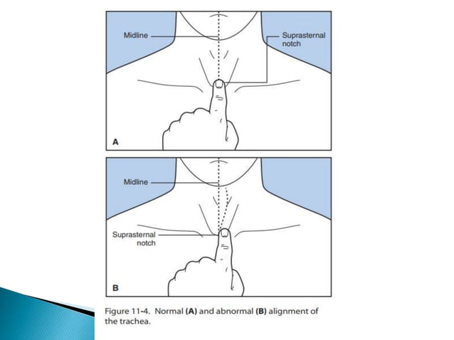 Chapter 11 Thoracic Injuries | PPTX
