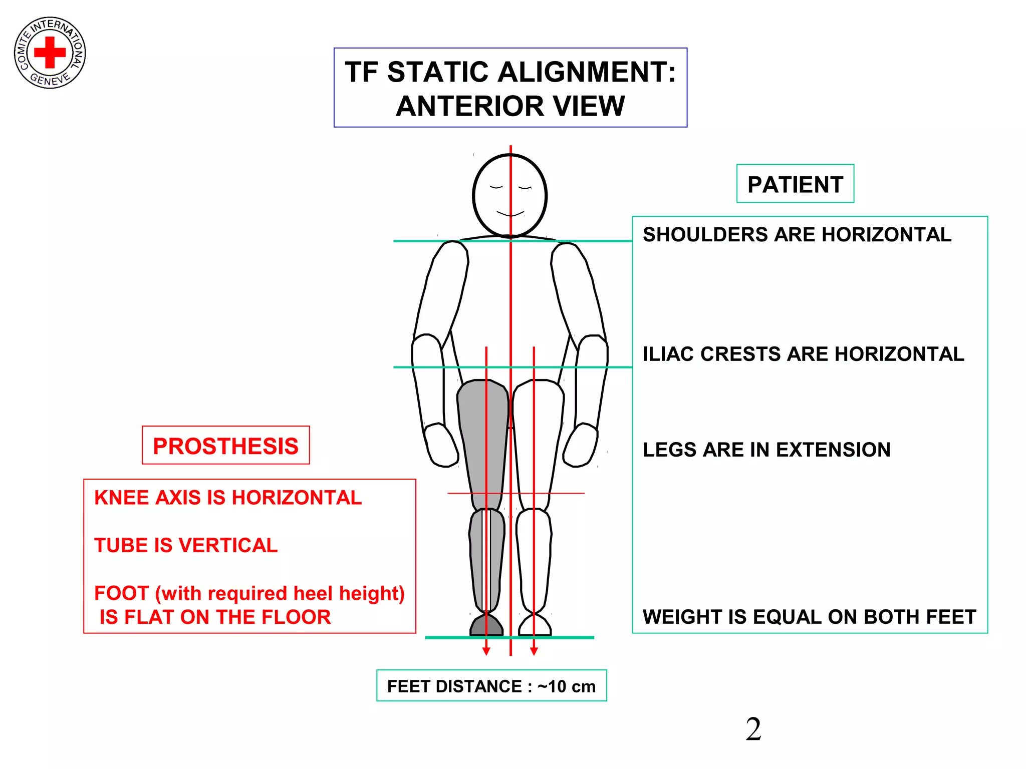 Transfemoral Static Alignment | PPT