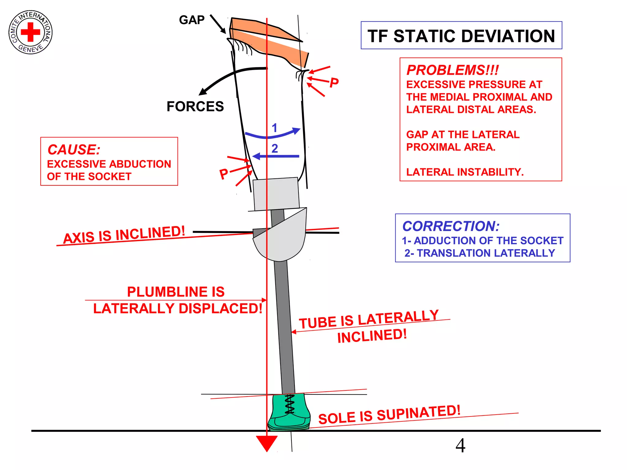 Transfemoral Static Alignment | PPT